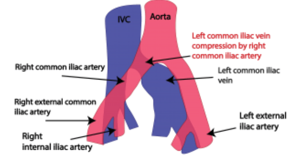May Thurner Syndrome What Sonographers Should Know